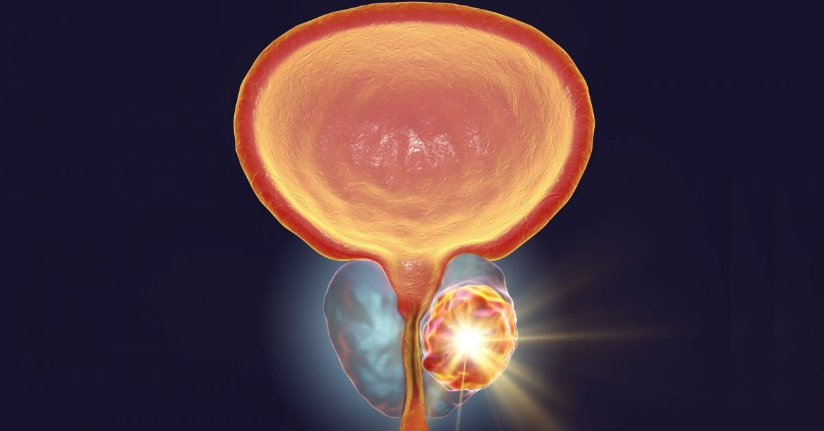 Fokale Therapien bei Prostatakrebs – welche gibt es?